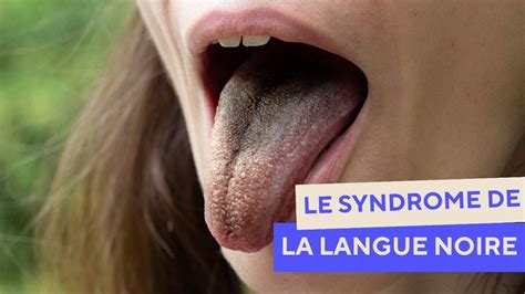 Qu Est Ce Que Le Syndrome De La LANGUE POILUE YouTube