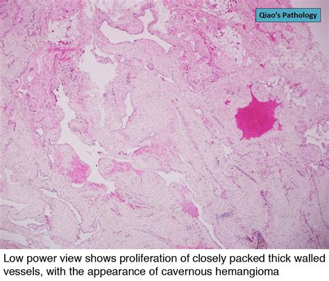 Capillary Hemangioma Lip Pathology Outlines Sitelip Org
