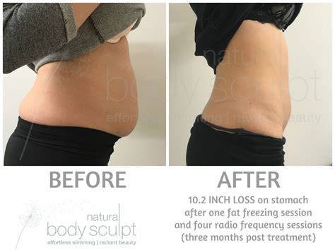 Fat Freezing Ice Lipo Natural Body Sculpt