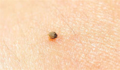 Rickettsia qué es síntomas y cómo se contagia