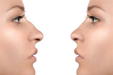 Rinoplastie Chirurgie Plastica
