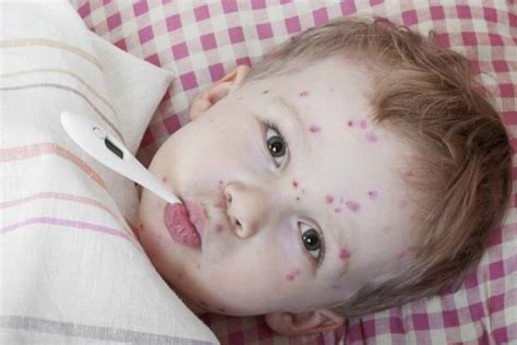 Las 5 enfermedades más comunes en los niños CLINICA UPLA Trayssi Ruby