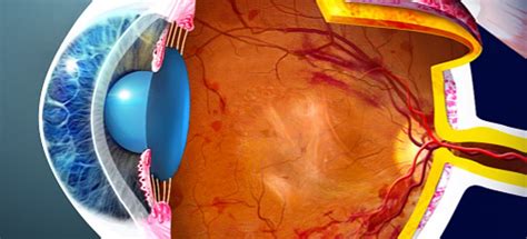 Retinopatia Diabética Centro Oftalmológico