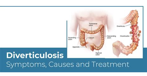 What Is Diverticulosis Symptoms Causes And Treatment