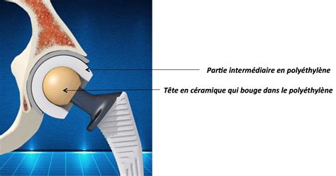 Prothèse totale de hanche Clinique Ostéo Articulaire des Cèdres
