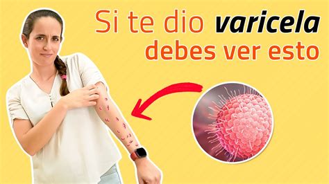 Herpes Z Ster Qu Es S Ntomas Y Tratamiento Youtube