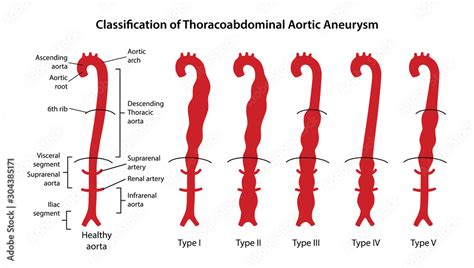Classification Of Thoracoabdominal Aortic Aneurysms Healthy Aorta With