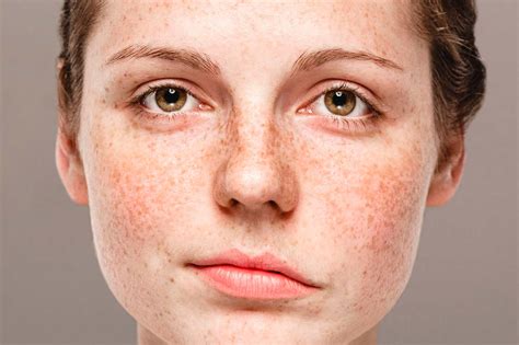 Parálisis Facial Comprender Superar y Recuperar la Sonrisa Todos
