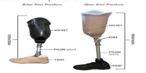 Module Prosthetics Flashcards Quizlet