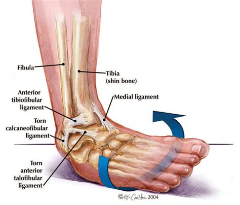 Ankle Sprain Classification Dr Steve Edwards