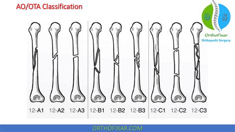 Humeral Shaft Fractures OrthoFixar 2024