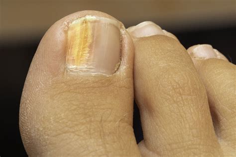 Onicomicosis Van Caester Dermatologia