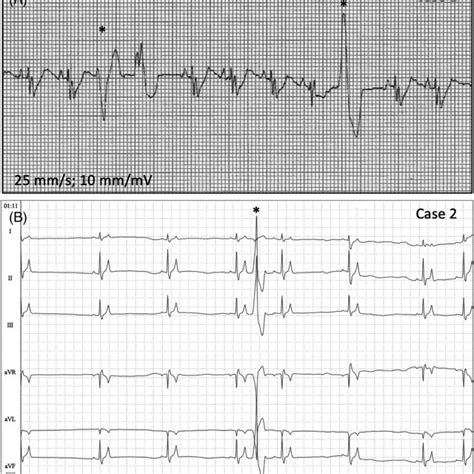 Lead II ECG In Case 1 A Documenting A Sinus Rhythm With Complexes