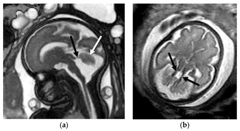 diagnostics free full text clinical applications of fetal mri in the brain