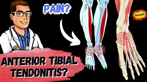 Tibialis Anterior Tendonitis Tendonitis On TOP Of Foot Treatment