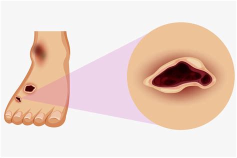 Difference Between Arterial Leg Ulcers Vs Venous Leg Ulcers