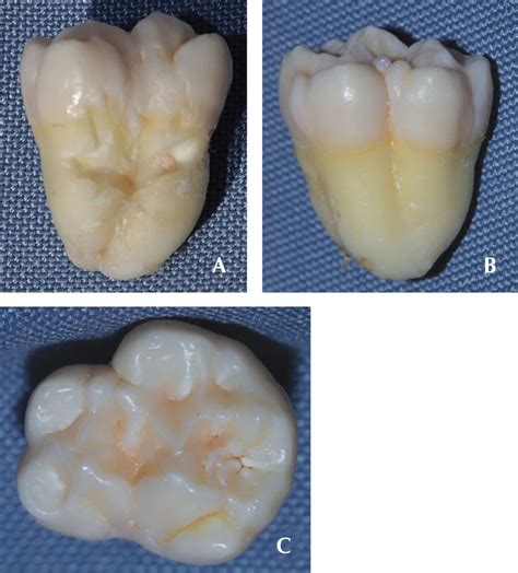 Fusión del tercer molar inferior con un cuarto molar Reporte de tres