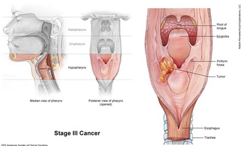 Throat Cancer Pictures Med Health Net