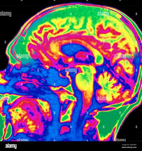 Brain Coloured Magnetic Resonance Imaging Mri Scan Of A Sagittal