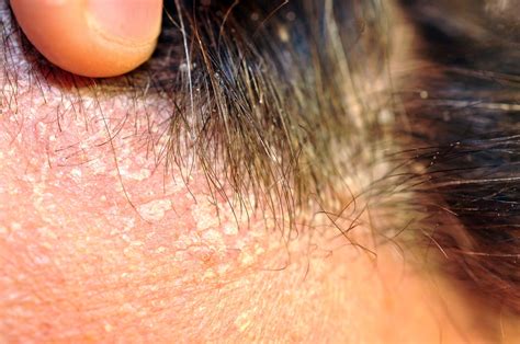 Dermatite seborreica o que é sintomas e como tratar Vida Saudável