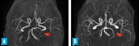 Vascularites primitives du système nerveux central La Revue du Praticien