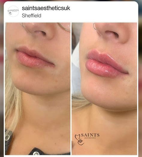Lip Flip Vs Lip Filler Artofit