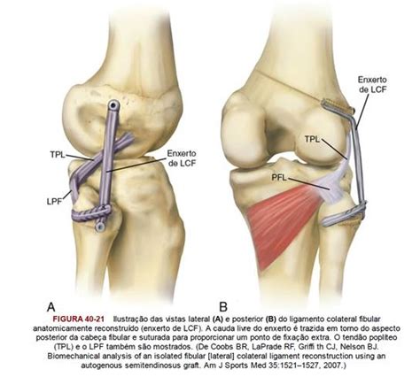 Ligamento Colateral Lateral E Posterolateral Dr Oliver Ulson