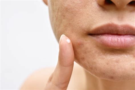 Tipos De Cicatriz De Acne E Como Cuidar Destas