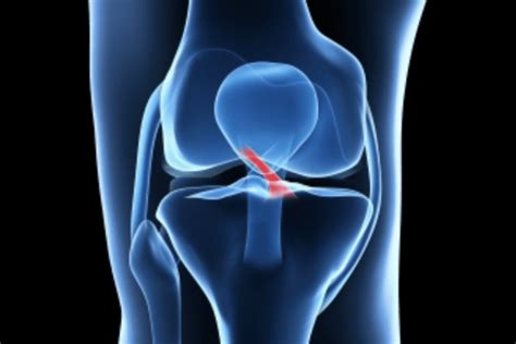Torn ACL Surgery Part 2 How Video Town Center Orthopaedics