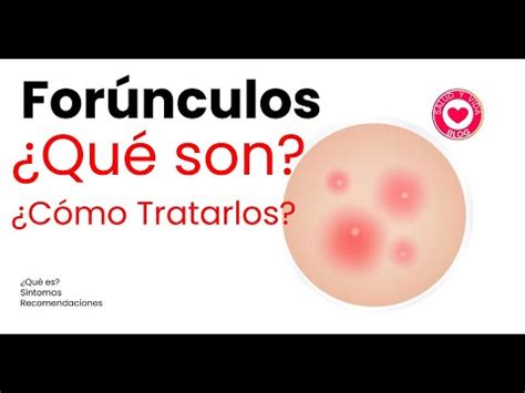 Los forúnculos qué son y cómo tratarlos YouTube
