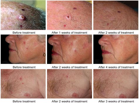 Actinic Keratosis Solar Keratosis Sun Spots
