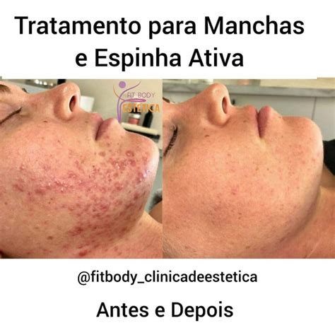 Manchas E Espinha Ativa Tratamento Cl Nica Fit Body Est Tica
