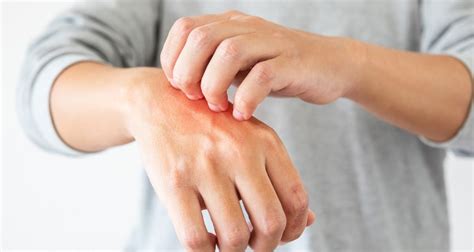 Disidrose Causas Sintomas E Como Tratar MundoBoaForma