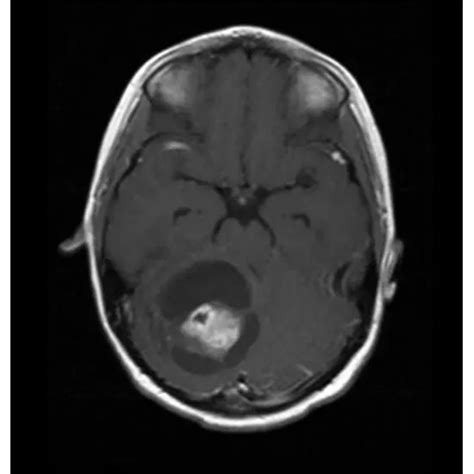 Cerebral Astrocytoma Types Causes Symptoms Treatment