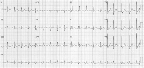 Vt Versus Svt Litfl Medical Blog Ecg Library Basics