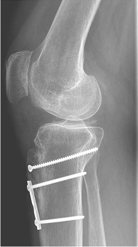 Example Lateral X Ray Of A Standard Fixation Of The Tibial Tuberosity