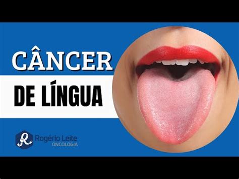Ferida na língua ou garganta 5 principais causas e como tratar 7