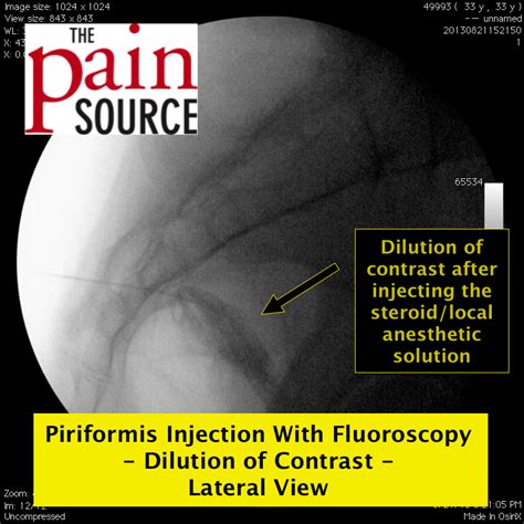 Piriformis Syndrome Injection