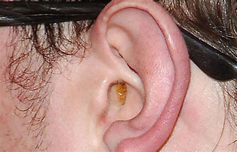 Interruption Casser Dinteragir Douleur Exterieur Oreille Ambassadeur