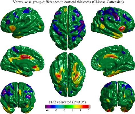 FIG URE 3 Vertex Wise Group Differences In Cortical Thickness Removing