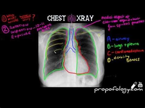 How To Read A Chest Xray In 5 Minutes Clinical YouTube Medical