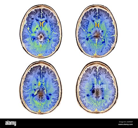 Multiple Sclerosis Coloured Magnetic Resonance Imaging MRI Scans Of