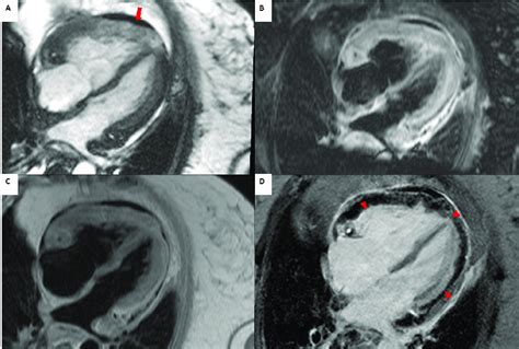A Steady State Free Precession SSFP Cine Imaging Showing An