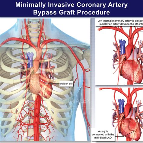 Minimally Invasive Coronary Artery Bypass Graft Procedure