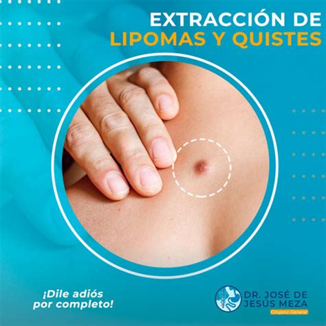 Por qué salen los quistes Dr José Meza Cirujano Gastroenterólogo