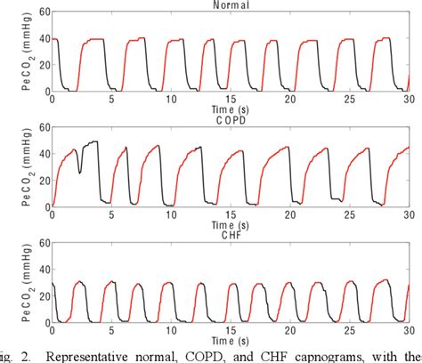 figure 3 from automated quantitative analysis of capnogram shape for copd normal and copd chf