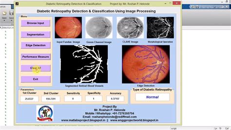 matlab code for diabetic retinopathy detection in fundus image using image processing youtube