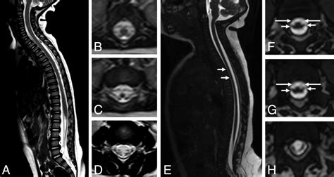 Abnormal Cervical Spine Mri