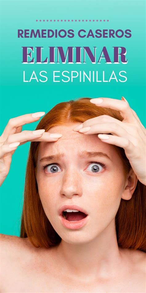 Dicas Tops Remedios Caseros Para Las Espinillas Como Quitar