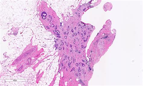 Pathology Outlines Tubular